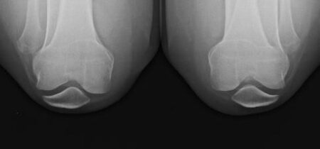 lesione legamento alare ginocchio, lateral release ginocchio